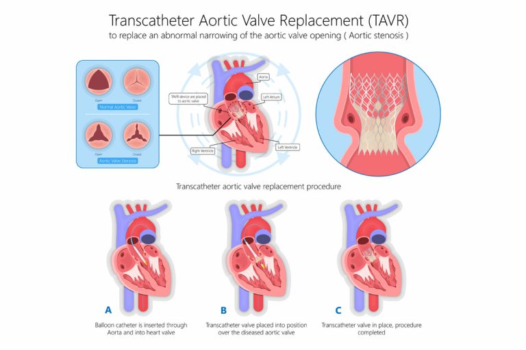 צנתור לב טאבי TAVI, החלפת מסתם אורטלי, פרופסור פול פפר